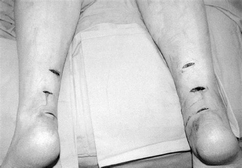 Figure 1 From Metasynchronous Bilateral Achilles Tendon Rupture