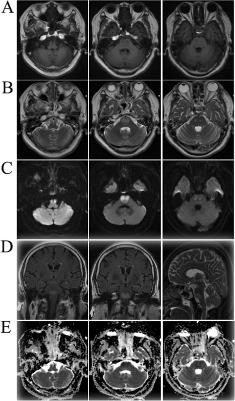 Cranial Magnetic Resonance Imaging Mri Indicated The Giant “heart