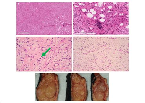 A Low Magnification Moderately Cellular Spindle Cell Neoplasm With