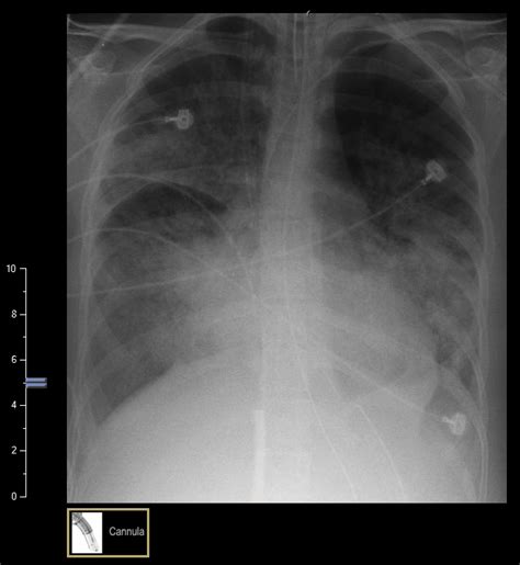Ecmo Simulation User Manual V54