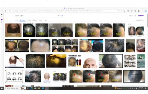 이미지 키워드 발모 또는 탈모 자료실 주식회사 비엔티