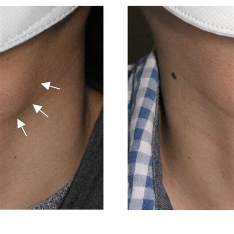 Photograph Of An External Neck With A Thyroglossal Duct Cyst The Mass