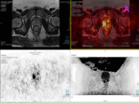 Prostate Fusion Biopsy Imaging Explained Open Medscience