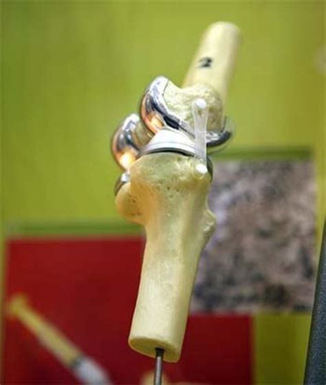 Recovery From Total Knee Replacement Surgery Hubpages