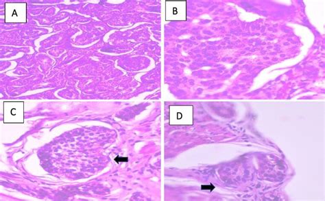 A Case Of Well Differentiated Neuroendocrine Tumor Of The Appendix In A