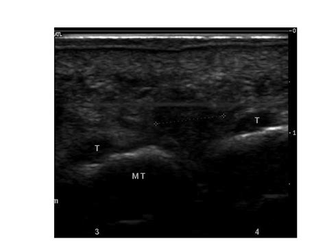 A Sonographers Guide To Forefoot Imaging Dr Iain Duncan