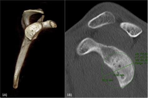 A Computed Tomography 3d Reconstruction Of The Scapula Showing The