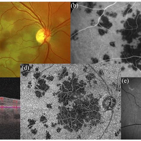 Multimodal Imaging Of Punctate Inner Choroidopathy Pic Complicated By