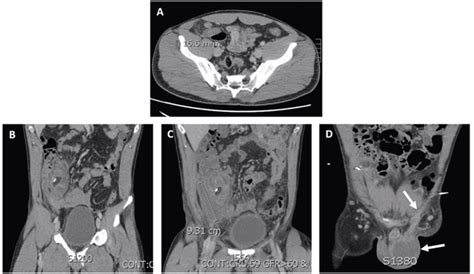 Hydrocele With Subsequent Scrotal Abscess In A 29 Year Old Male After Laparoscopic Appendectomy