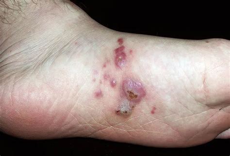 Picture Of Kaposis Sarcoma Ecchymotic Picture Image On