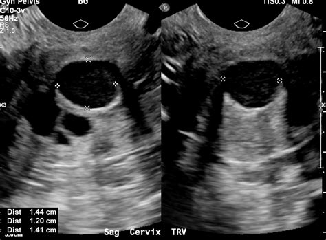 Cervix Nabothian Cysts Uterus