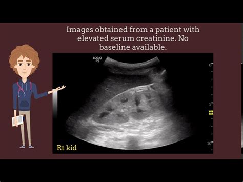Increased Renal Cortical Echogenicity Does Not Always 48 Off