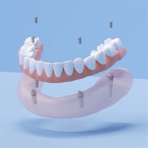 Dental Implant Types