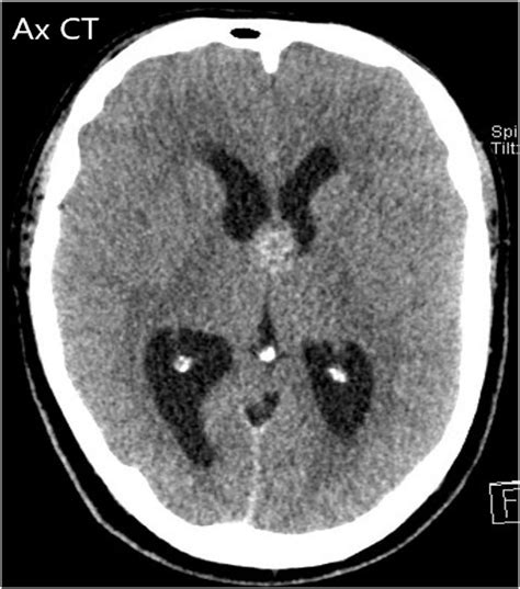 Non Contrast Axial Ct Brain Image Showed Midline Ill Defined