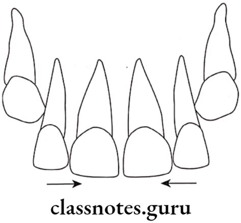 Development Of Dentition And Occlusion Orthodontics Short And Long
