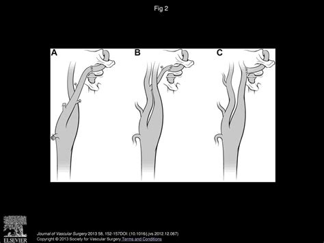 Contemporary Outcomes After Distal Vertebral Reconstruction Ppt Download
