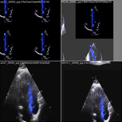 基于yolov8深度学习的心脏间隔壁检测与分割系统pyqt5界面数据集训练代码 中猿创新 7zcode