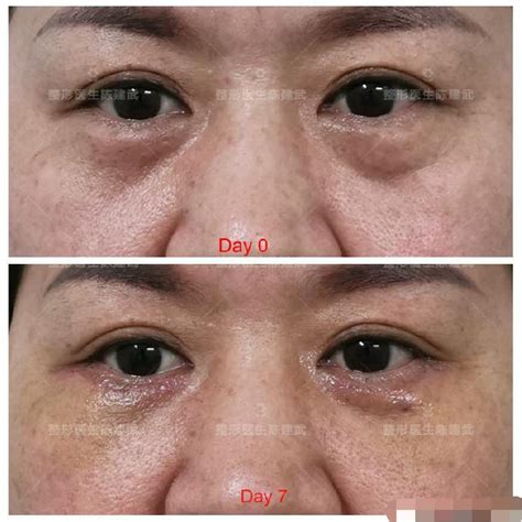 50岁女性外切眼袋术后，泪沟改善了，眼袋也变小了 知乎