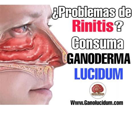 Ganoderma Vs Rinitis Ganoderma Lucidum