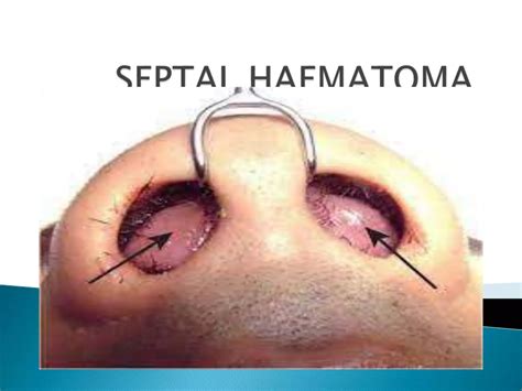 Septal Haematomapptx