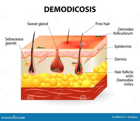 Demodicosis Demodex Mite Stock Vector Illustration Of Inflammation