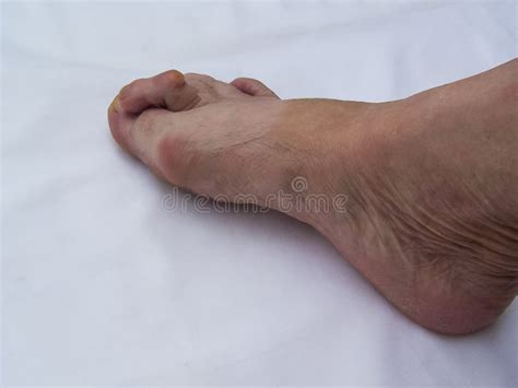 Valgus Deformity Of Female Leg Due Hallux Valgus And Weakness Of
