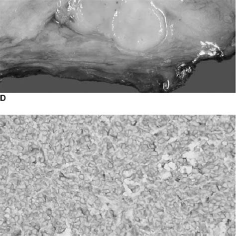 Primary Primitive Neuroectodermal Tumors In 33 Year Old Woman With Download Scientific Diagram