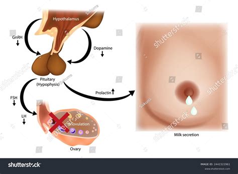 Hyperprolactinemia Milk Secretion Abnormally High Levels Stock Vector