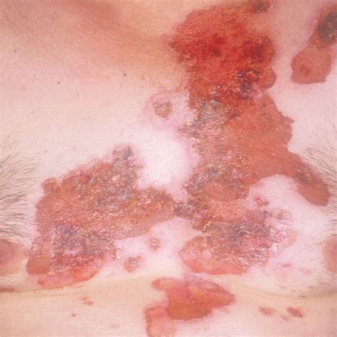 Pemphigus Best Skin Clinic In Gurgaon