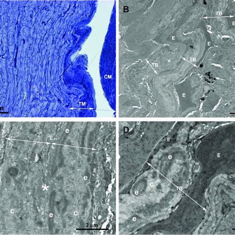 Case 1 Trabeculectomy Sample From The Right Eye A Light Micrograph