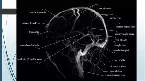 Dural Venous Sinus Thrombosis For Radiology And Imaging Ppt