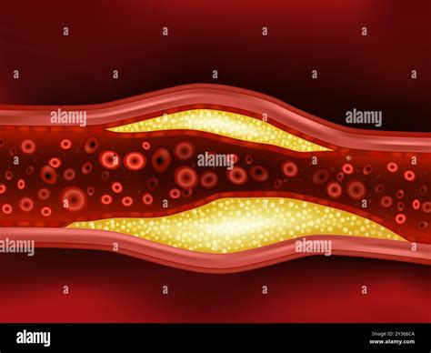 Cholesterol Plaque In Artery Atherosclerosis Stock Vector Image And Art