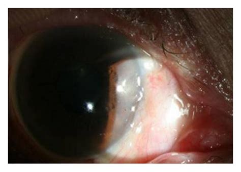 Case 1 A Preoperative Photograph A 2 9 × 5 3 Mm Sized Scleral