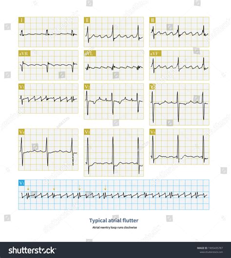 During Atrial Flutter Flutter Wave Inferior Stock Illustration
