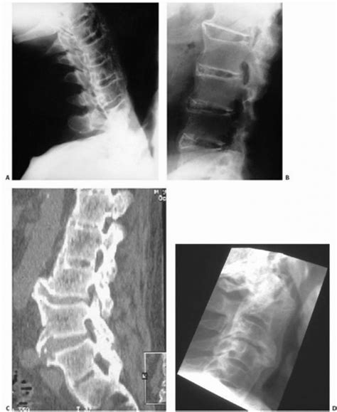 Skeletal And Extraskeletal Calcification And Ossification Syndromes Basicmedical Key