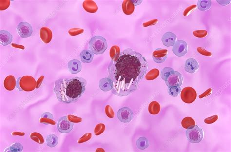 Auer Rods In Acute Promyelocytic Leukaemia Illustration Stock Image F0391152 Science