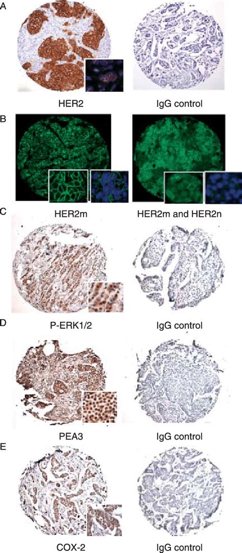 A Immunohistochemical Localisation Of Her2 100 With Fluorescent