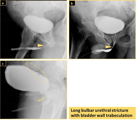 Bladder Trabeculation