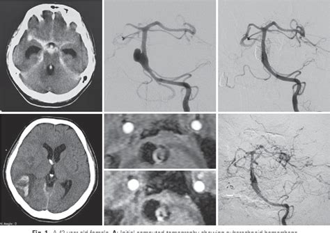 Coil Embolization Of Ruptured Basilar Artery Aneurysm At Russell Weyand