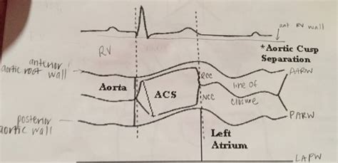 Chapter 3 Echo Flashcards Quizlet