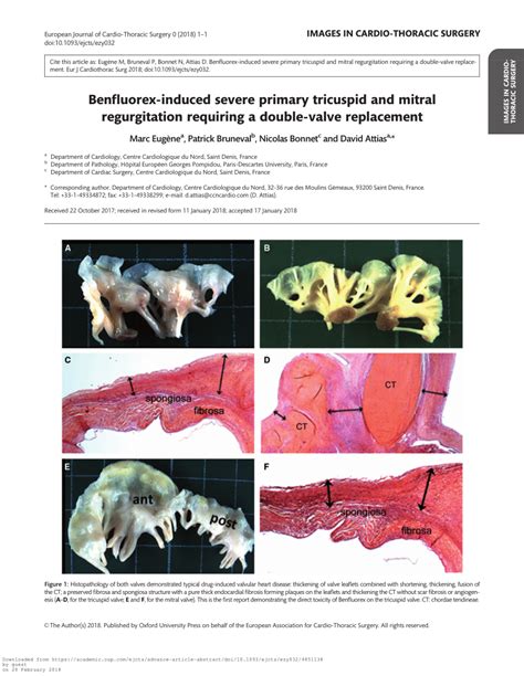 PDF Benfluorex Induced Severe Primary Tricuspid And Mitral