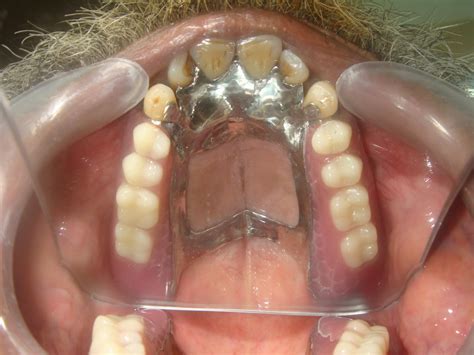 Step By Step Guide For Understanding The Prosthodontics A Step By Step