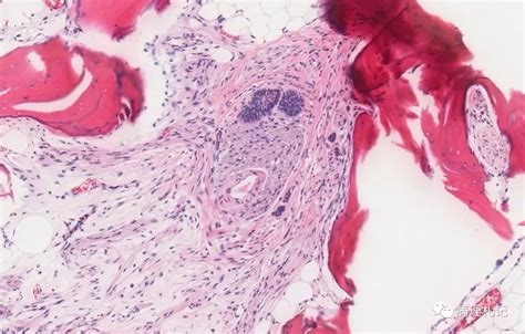 病理视角极为罕见的膀胱转移性子宫内膜间质肉瘤医学界 助力医生临床决策和职业成长