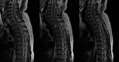 Dr Balaji Anvekar Frcr Spinal Cord Ischemia In A Case Of Aortic Dissection