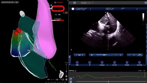 Federico Migliore Md Phd Faiac Fisc Fehra Fesc On Linkedin Effective Ablation Of Rvot Pvc