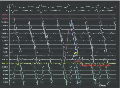 Simultaneous Recordings During Tachycardia In Case 2 From The Surface