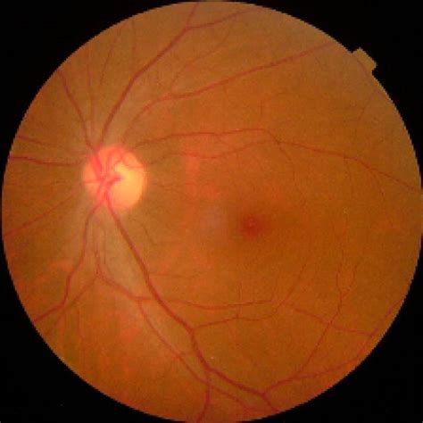 Detection Of Diabetic Retinopathy Using Machine Learning Classification
