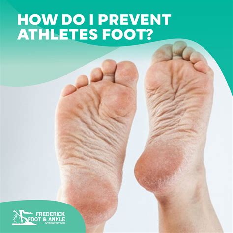 Frederick Foot And Ankle Frederick Md How Do I Prevent 55 Off