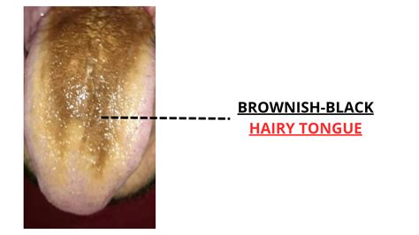 Hairy Tongue What It Is What Causes It And How To Treat It