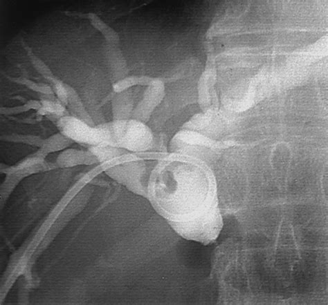 Cholangiocarcinoma Pictorial Essay Of Ct And Cholangiographic Findings Radiographics